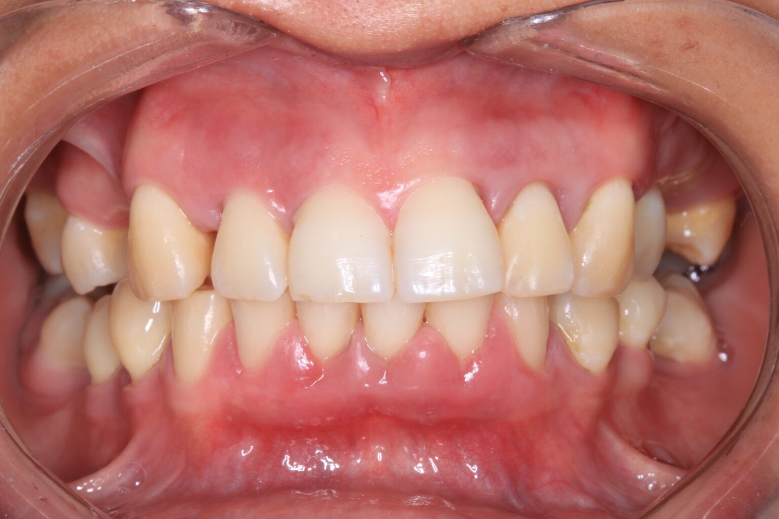 GENGIVA SAUDÁVEL, NÃO SANGRA! – Academia Pernambucana de Ciências